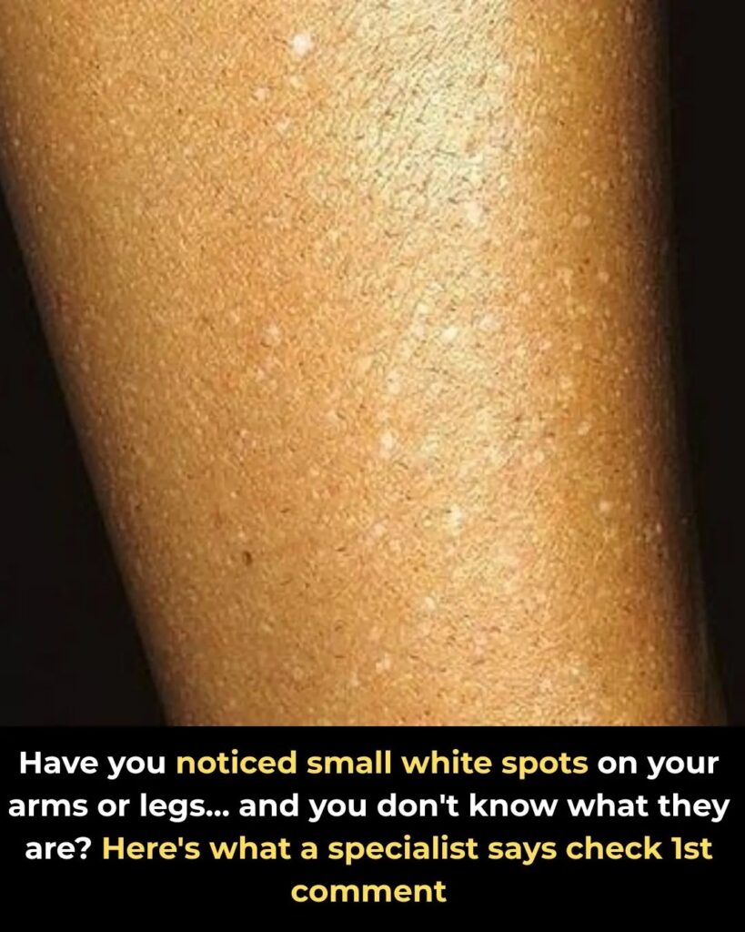 Have You Noticed Small White Spots on Your Arms or Legs and Don’t Know ...