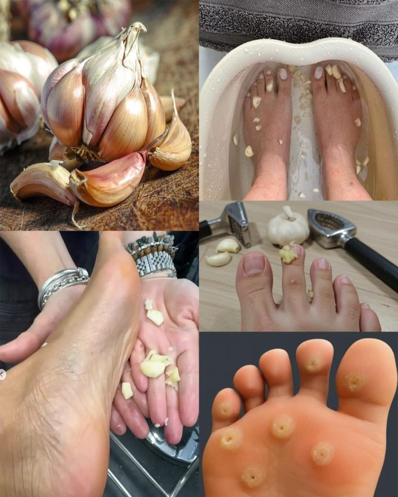 The Remarkable Power of Garlic for Foot Health: Benefits and Homemade ...