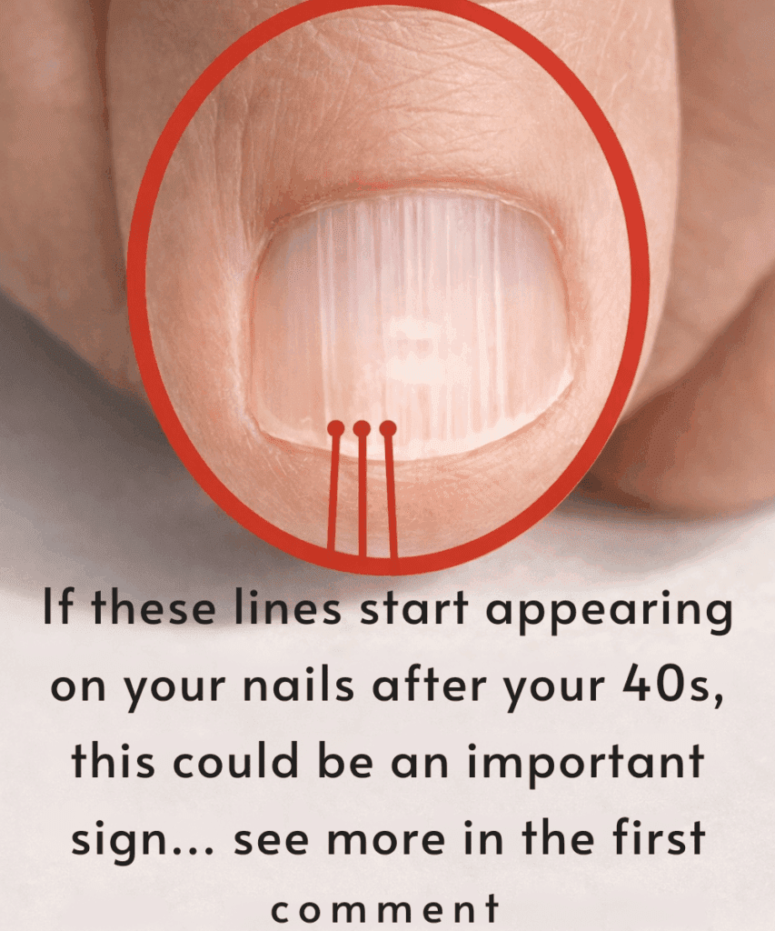 Vertical Ridges on Nails After 40: Why They Appear and When to Worry – USA