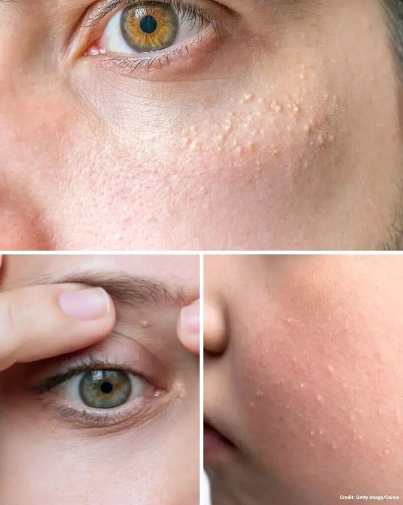 When these little white bumps appear on your skin, it means that… – USA