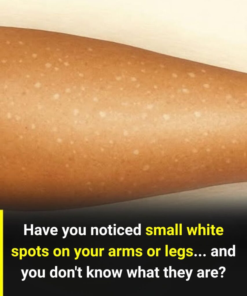 White Spots on Skin: Which Vitamin Deficiencies Could Be the Cause? – USA