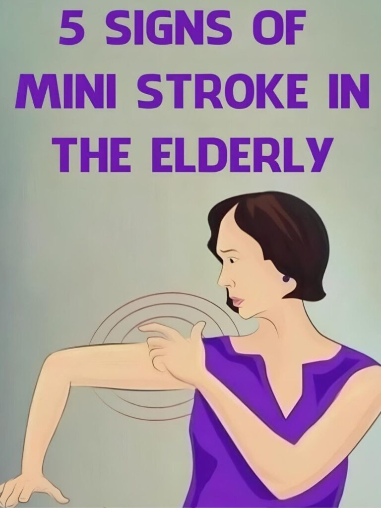 Signs of Mini Stroke (TIA) in the Elderly — And Why You Should Never ...